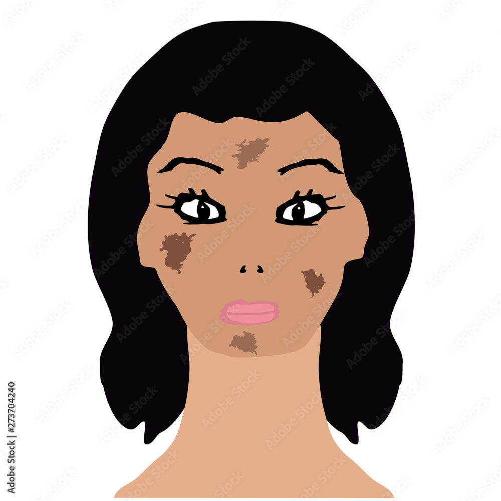 Face with pigmentation. Brown spots on the skin. Infographics. Vector ...