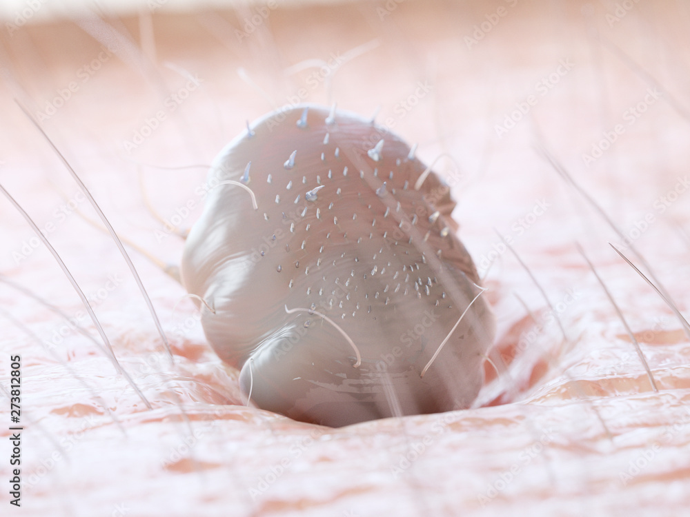 3d rendered medically accurate illustration of a scabies mite in human ...
