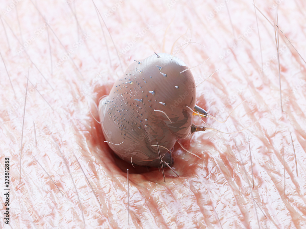3d rendered medically accurate illustration of a scabies mite in human ...