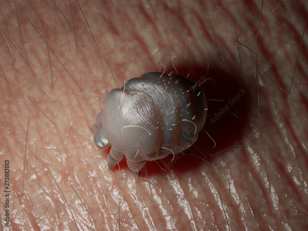 3d rendered medically accurate illustration of a scabies mite on human ...