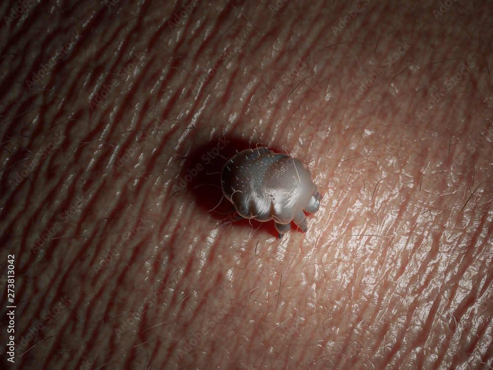Scabies Bug Pictures