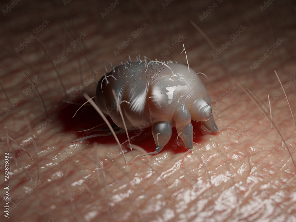 3d rendered medically accurate illustration of a scabies mite on human ...