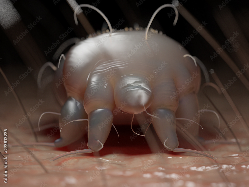 3d rendered medically accurate illustration of a scabies mite on human ...