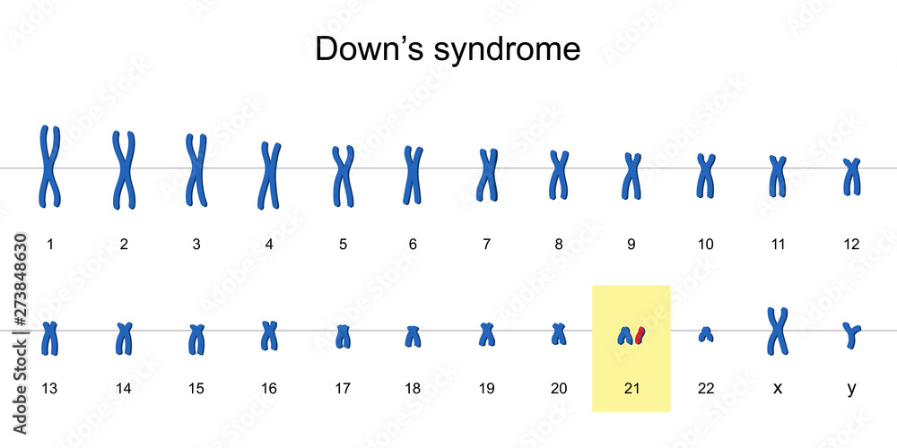 Down's syndrome karyotype Stock Vector | Adobe Stock