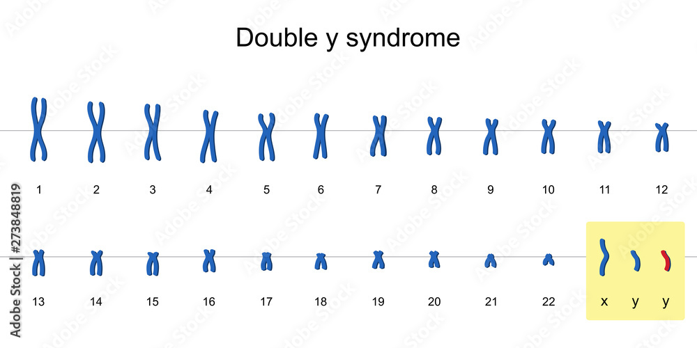 Double y syndrome karyotype vector ESP10 Stock Vector | Adobe Stock