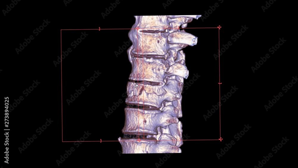 CT Scan of T-L spine or thoracolumbar junction spine 3D rendering image ...