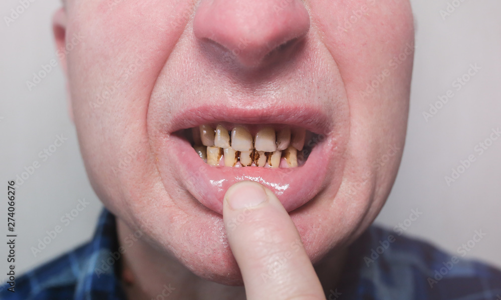 Plaque teeth cavities and paradontosis in the man's mouth. Dental decay ...