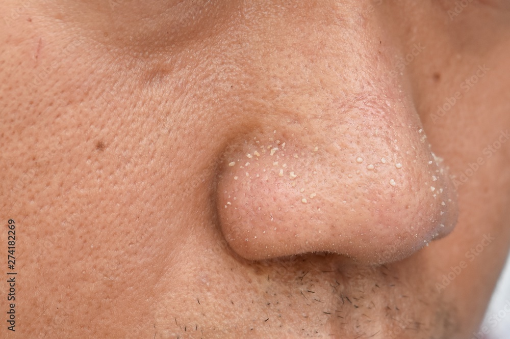 acne vulgaris on nose of asian man Stock Photo | Adobe Stock