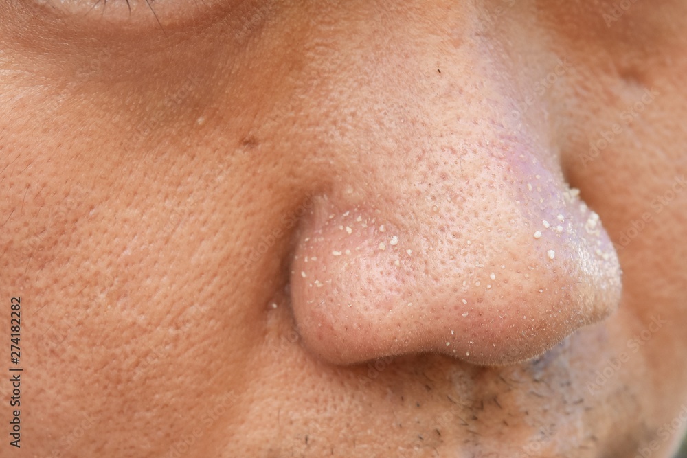 acne vulgaris on nose of asian man Stock Photo | Adobe Stock