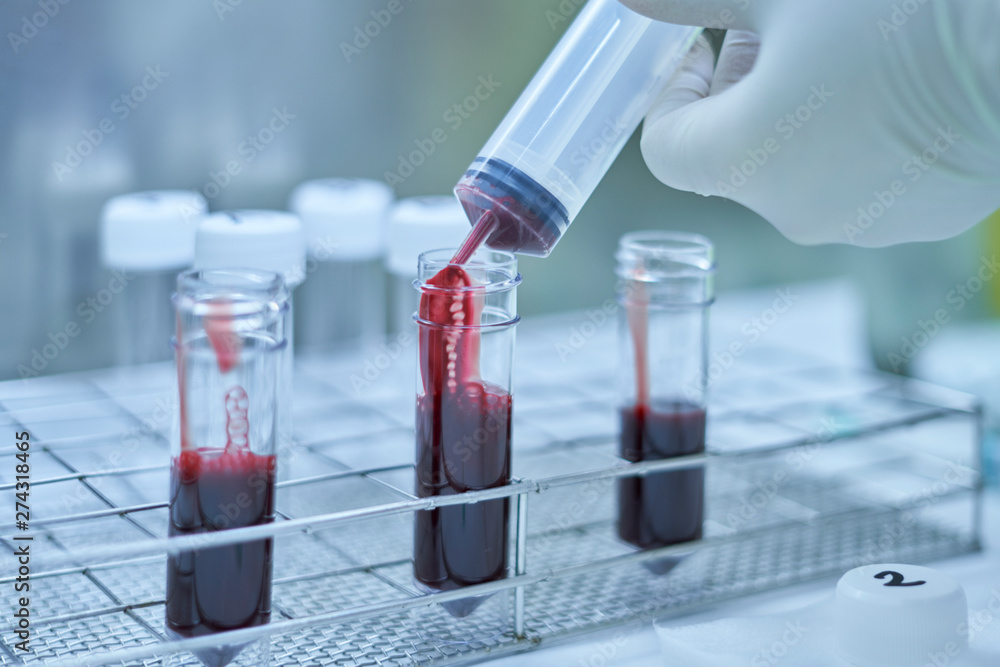 hand pouring blood in to plastic bottle, Hospital laboratory. Stock ...