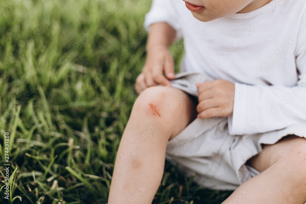 photo of a little girl who fell and scratched his knee in the blood, it ...