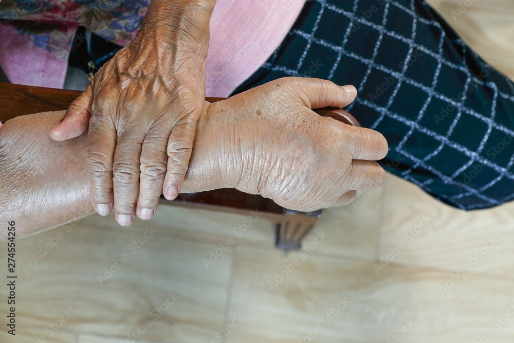Elderly swollen hand or edema hand Stock Photo | Adobe Stock