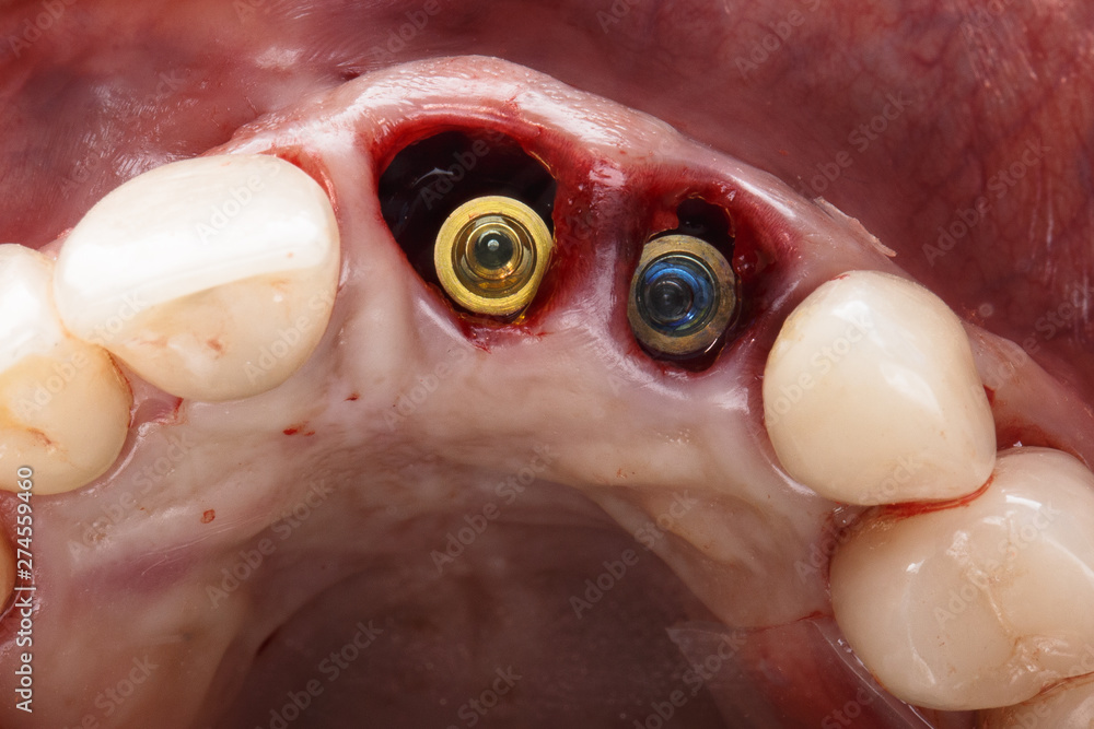 installation of special abutments after implantation for installation ...