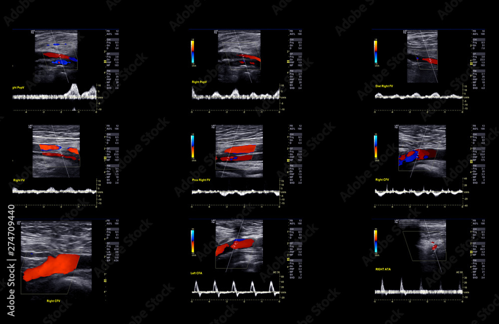 Ultrasound doppler for finding deep vein thrombosis of lower extremity ...