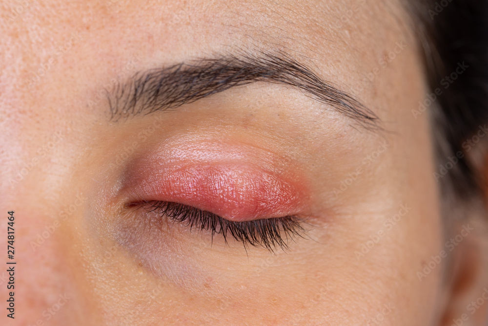 Macro Of A Womans Eye With Swollen And Inflamed Eyelid Symptoms Of