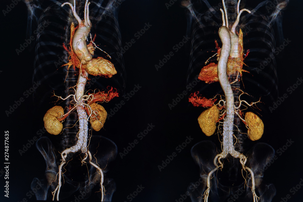 X-ray medical scan in hospital. CTA, CT angiography 3D rendering image ...