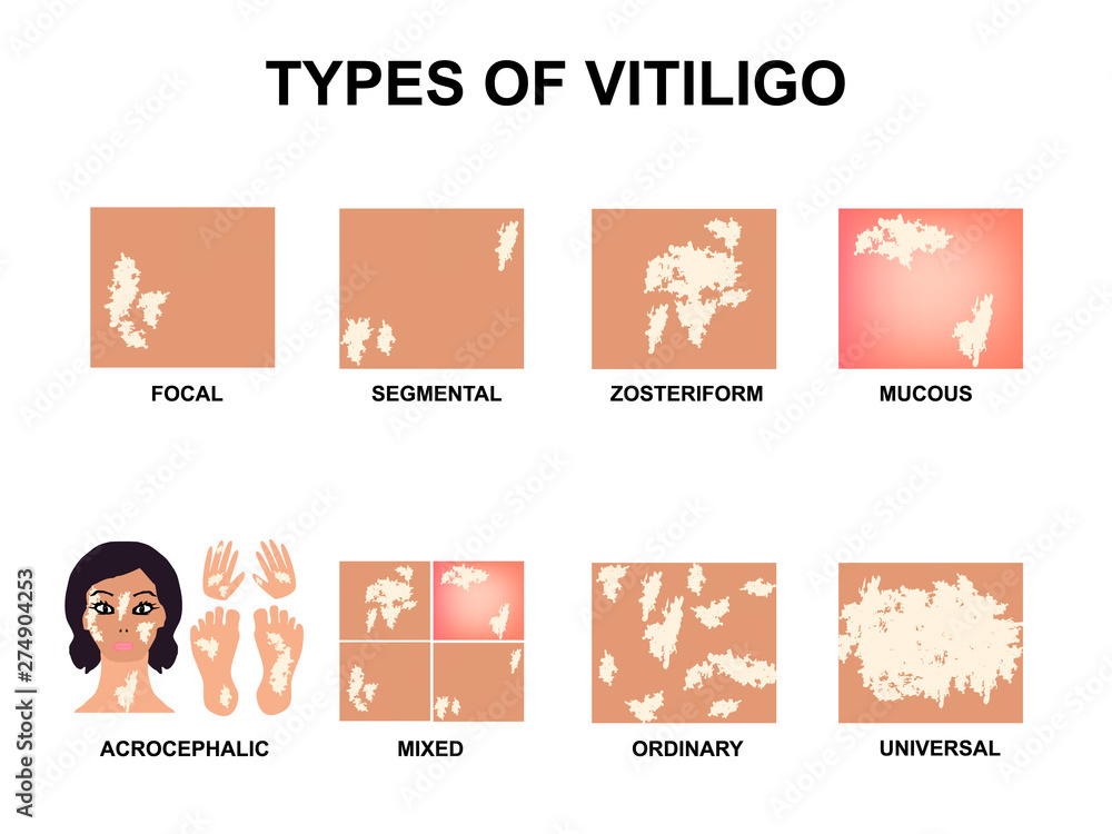 Types of vitiligo. World Vitiligo Day. Infographics. Vector ...