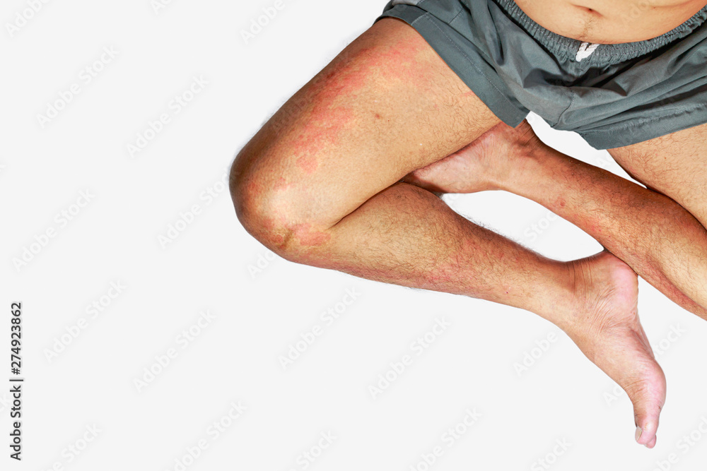 Leg area of men with dermatitis of rash ,allergy rash and Health ...