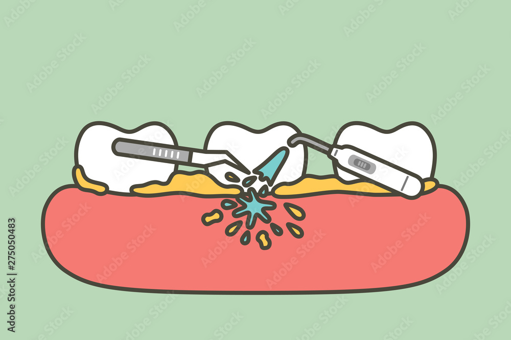 teeth scaling, dental plaque removal for cleaning - tooth cartoon ...