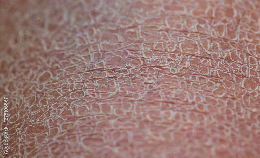 dry unhealthy skin texture covered with small and large cracks and dead ...