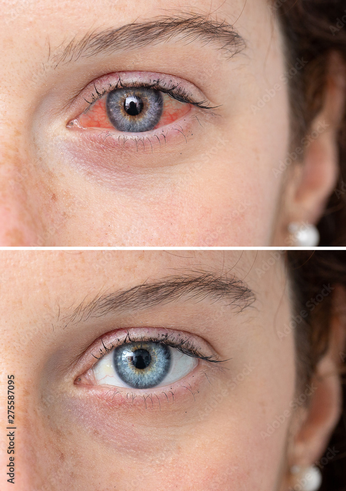 Conjunctivitis, red eyes, treatment Stock Photo | Adobe Stock