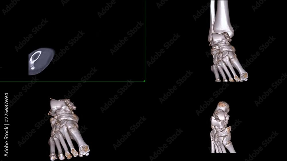 Vidéo Stock Multi view of CT ankle joint or CT Scan of Right ankle 2D ...