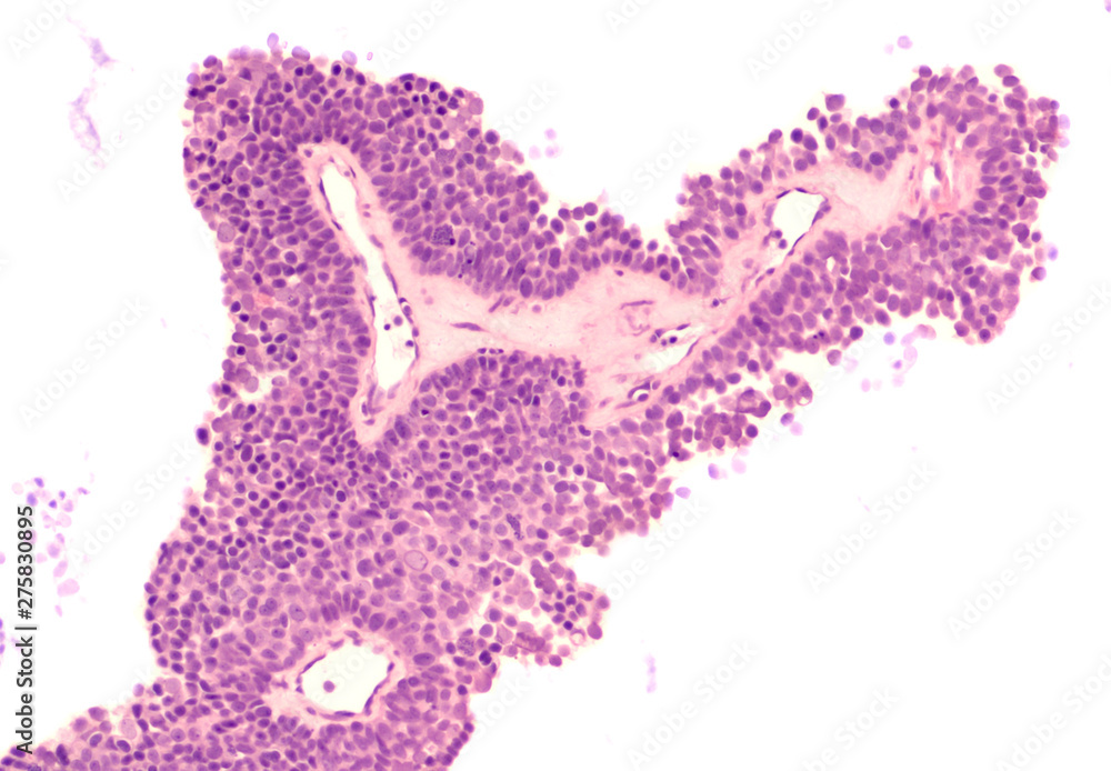 Bladder biopsy from a patient with bloody urine showing a papillary ...