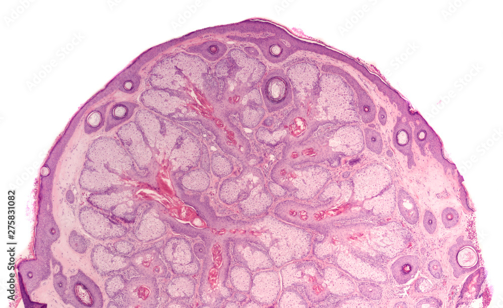 Microscopic image of a skin biopsy of a bump from an elderly man's nose ...