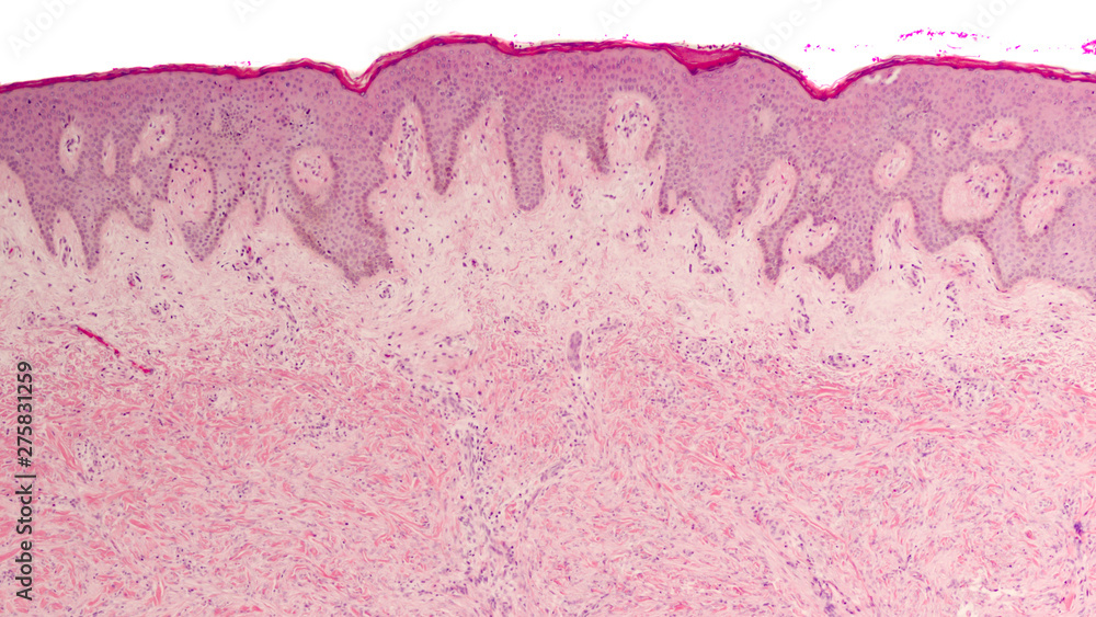 Tumors of Skin: Microscopic image (photomicrograph) of a dermatofibroma ...