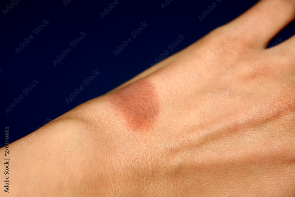 Burn Mark On Skin