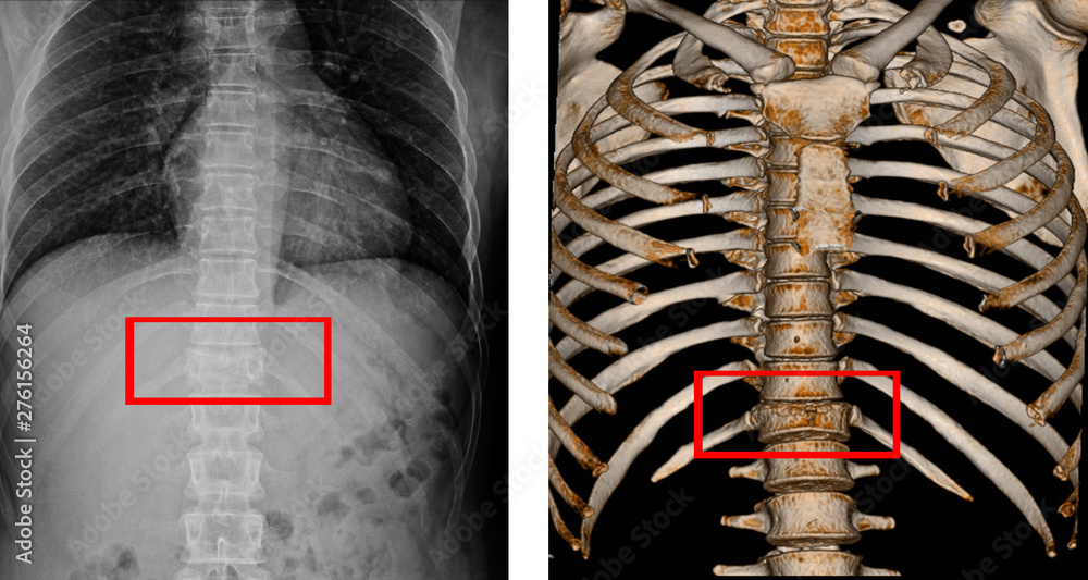 Ct Scan Thoracic Spine 3d And X Ray Thoracic Spine Finding Fracture T11