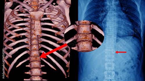CT Scan Thoracic spine 3D and x-ray Thoracic spine finding fracture T11 ...