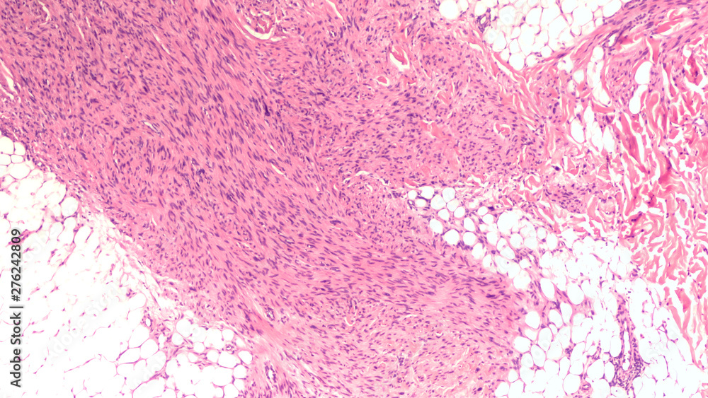 Photomicrograph of a malignant peripheral nerve sheat tumor (neurogenic ...