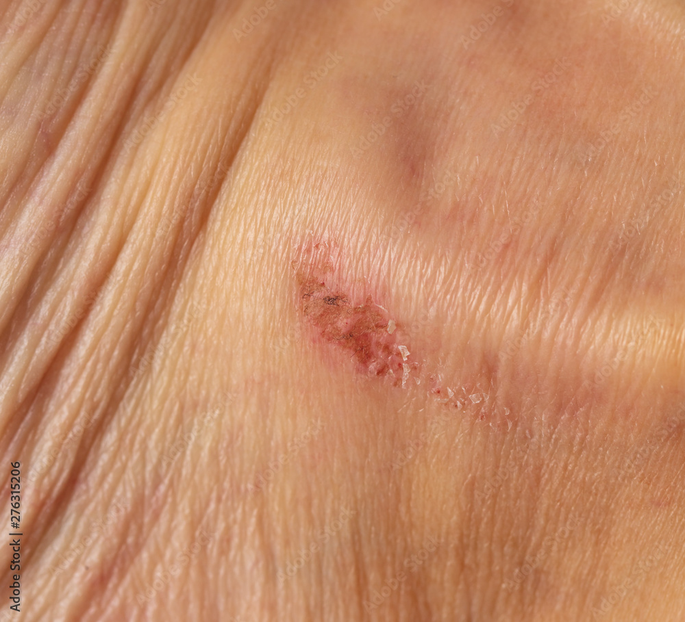 Wound on human skin as a background Stock Photo | Adobe Stock