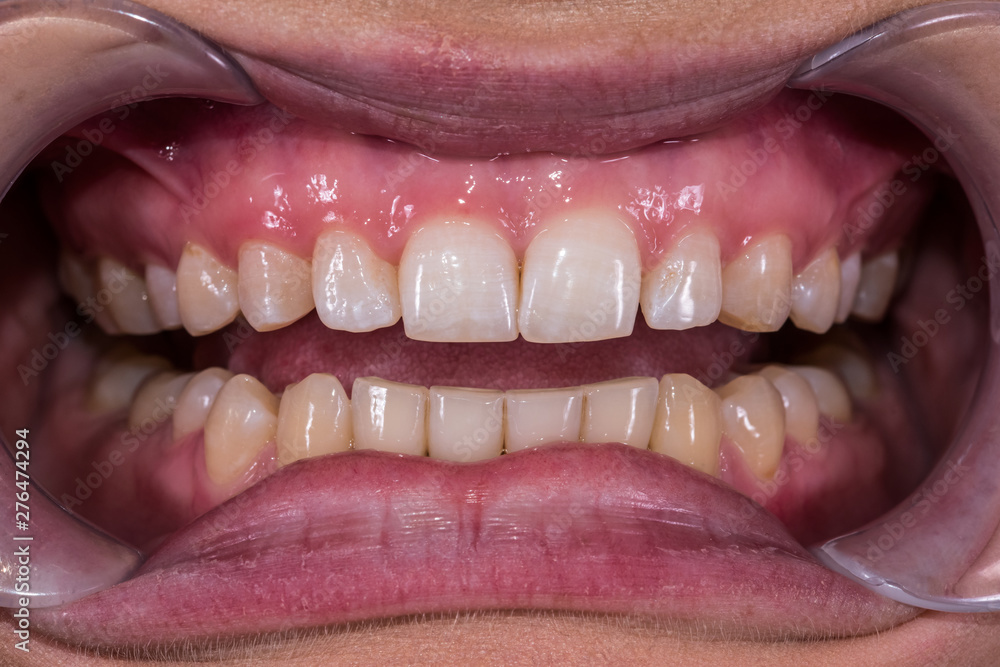 Healthy human teeth with normal occlusion from frontal intraoral view ...