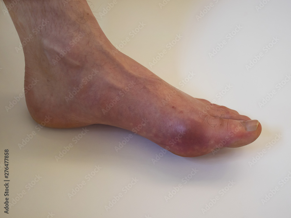 .Foot disease Rheumatism and gout. Red leg swelling. Pain in the foot ...