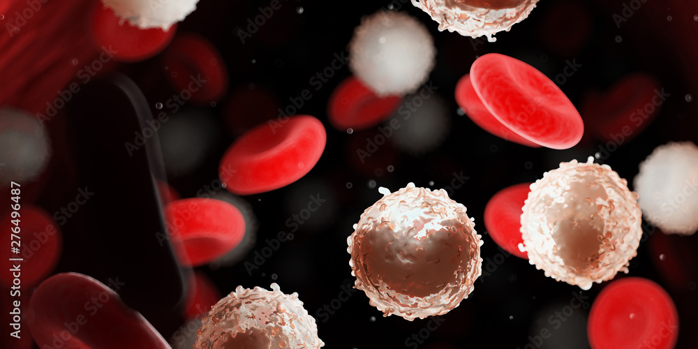 3d rendered medically accurate illustration of too many white blood ...