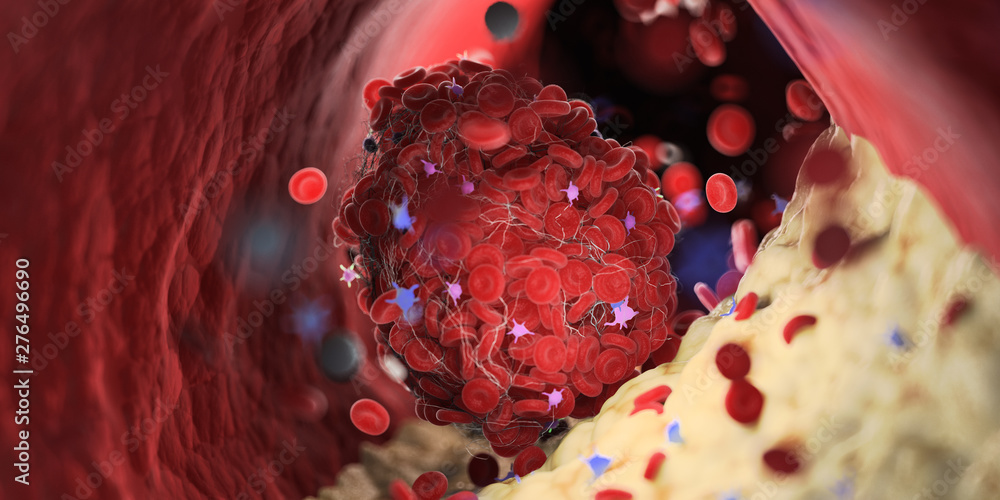 3d rendered medically accurate illustration of a thrombus emerging from ...
