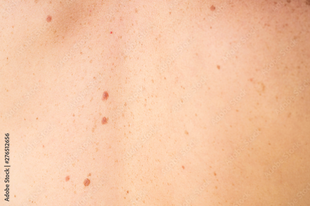 Close up detail of the bare skin on a man back with scattered moles and ...