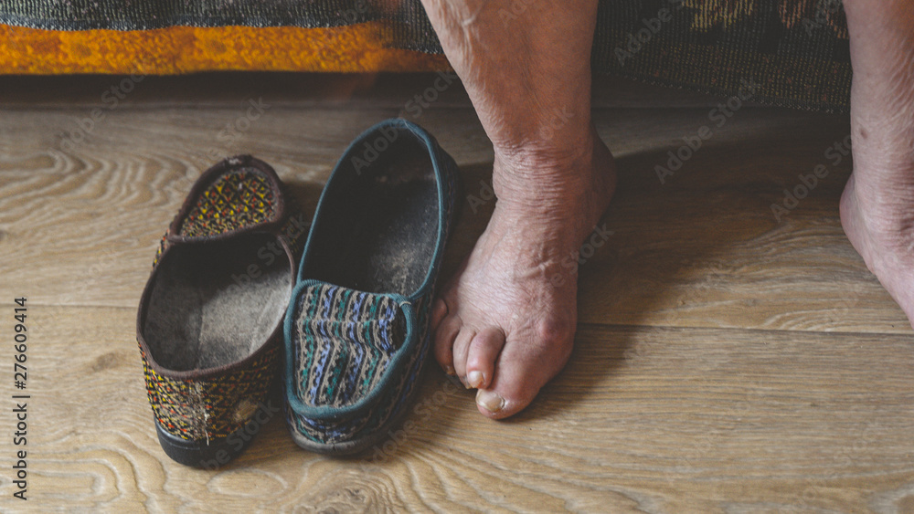 old feet, damaged toes and wrinkled legs with veins of old woman. old ...