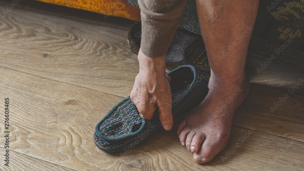 Foto de old feet, damaged toes and wrinkled legs with veins of old ...