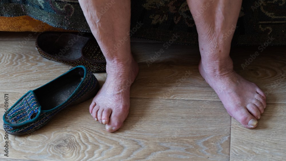 old feet, damaged toes and wrinkled legs with veins of old woman. skin ...