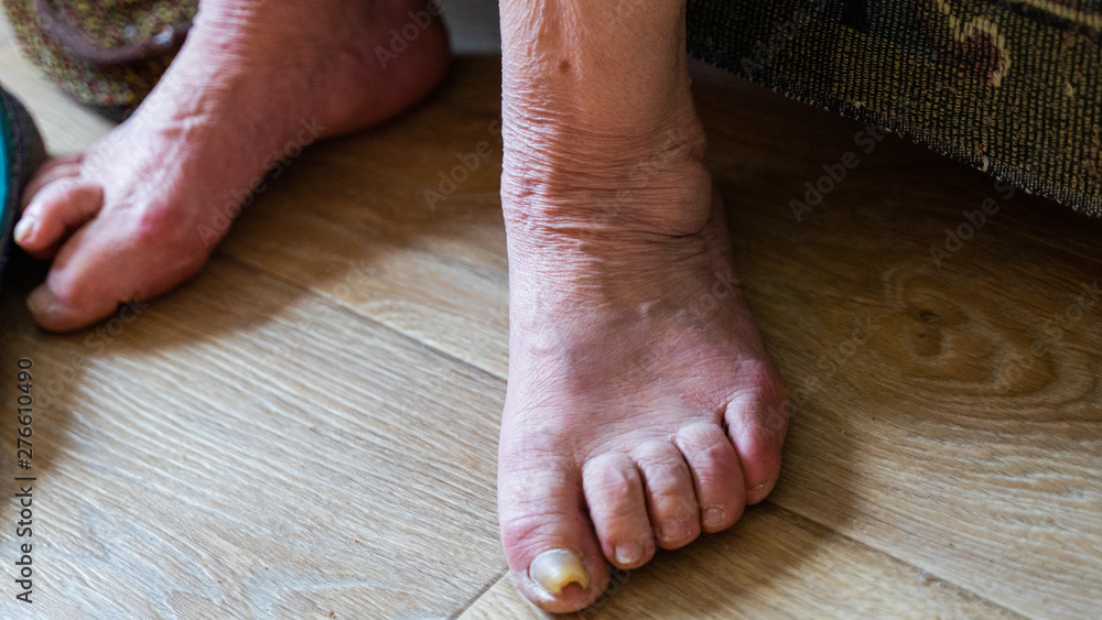 old feet, damaged toes and wrinkled legs with veins of old woman. Stock ...