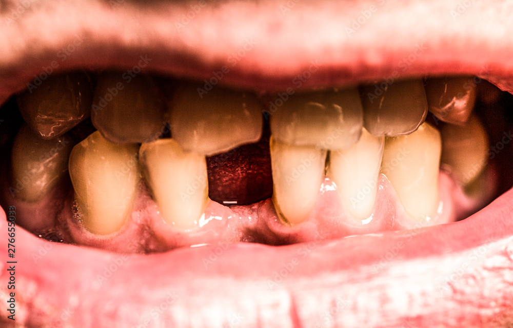 Man without one front tooth. No teeth. Yellow teeth. Bad dental health ...
