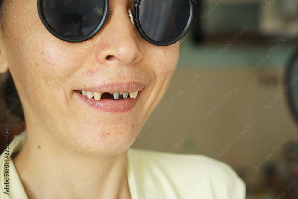 Ugly smile dental problem. Teeth Injuries or Teeth Falling in female ...