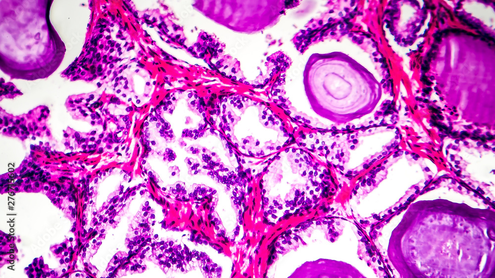 Histopathology of prostate gland hyperplasia, light micrograph, photo ...