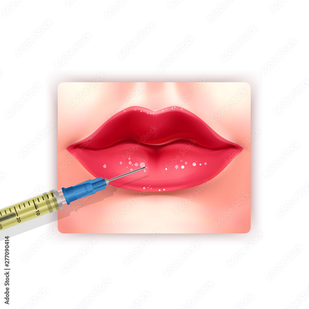 Lips injection, Lip Augmentation. injectable cosmetic filler. Vector ...