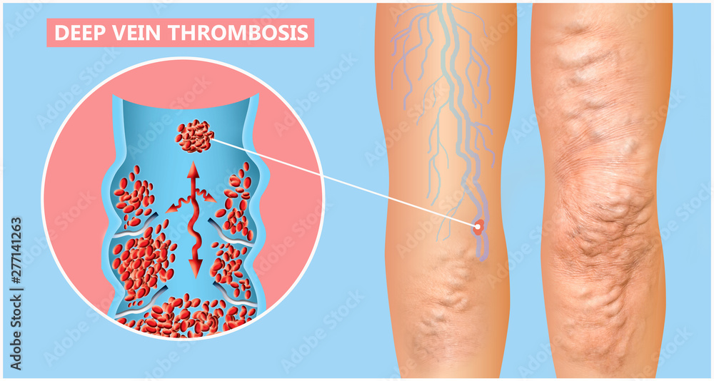 Deep Vein Thrombosis or Blood Clots. Embolus. Stock Photo | Adobe Stock