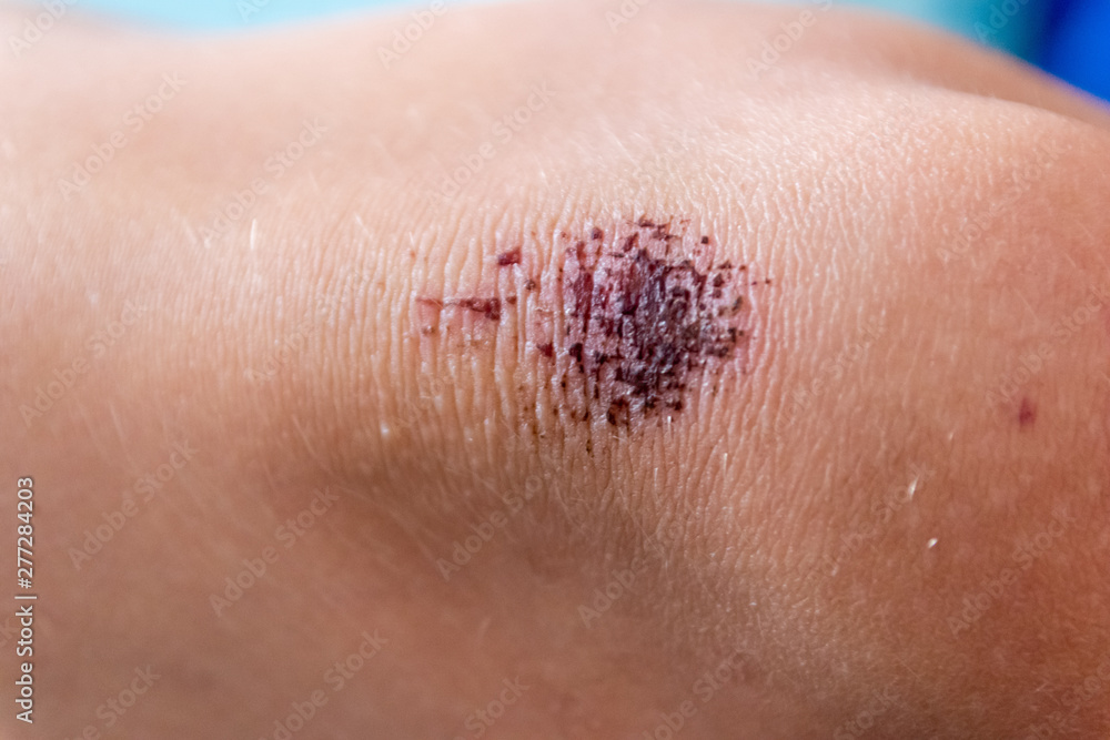 Schürfwunde am Knie eines Kindes mit roter Kruste aus Blut nach einem ...