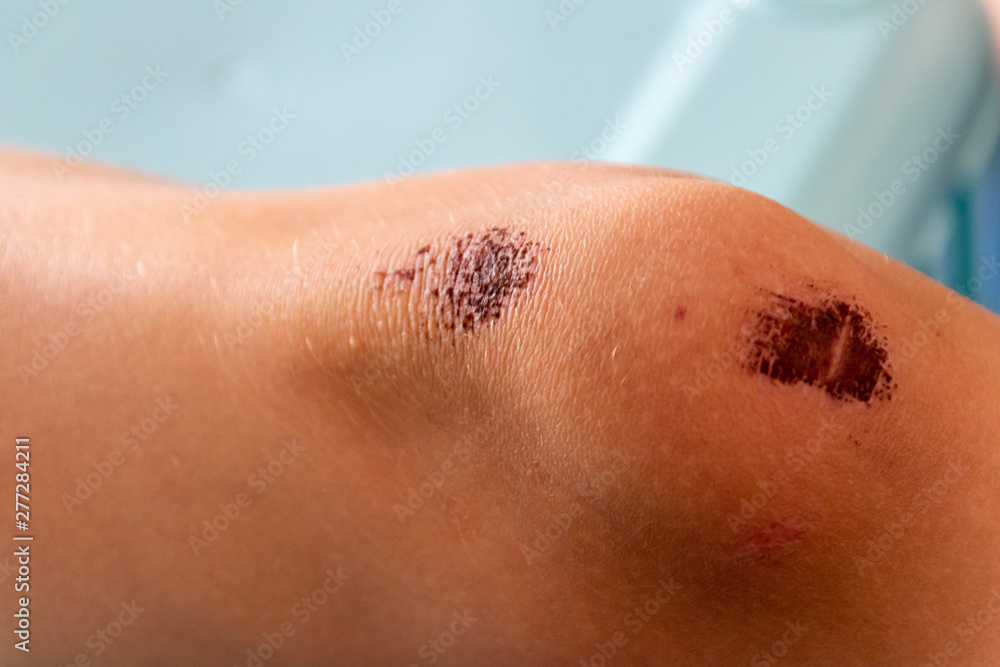 Schürfwunde am Knie eines Kindes mit roter Kruste aus Blut nach einem ...